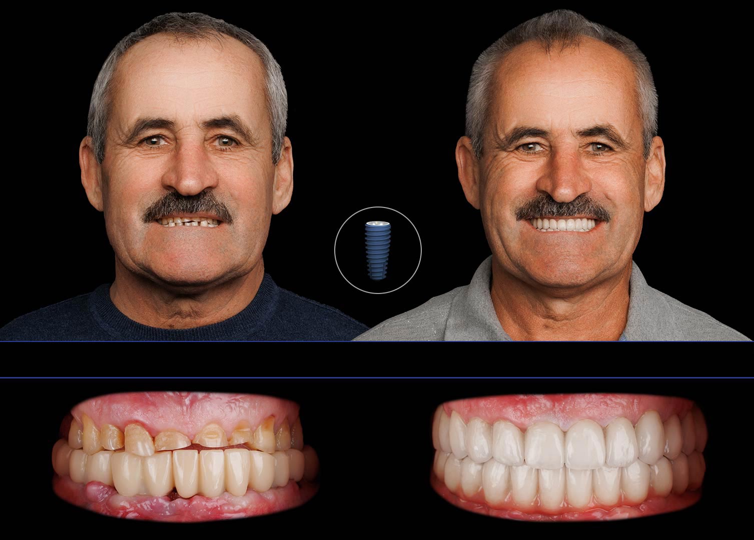 Rezultate Implantare - DentusDentino