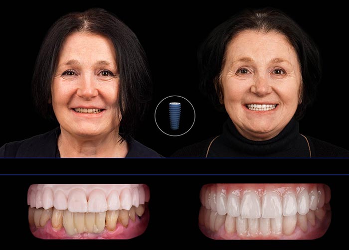 Rezultate Implantare - DentusDentino