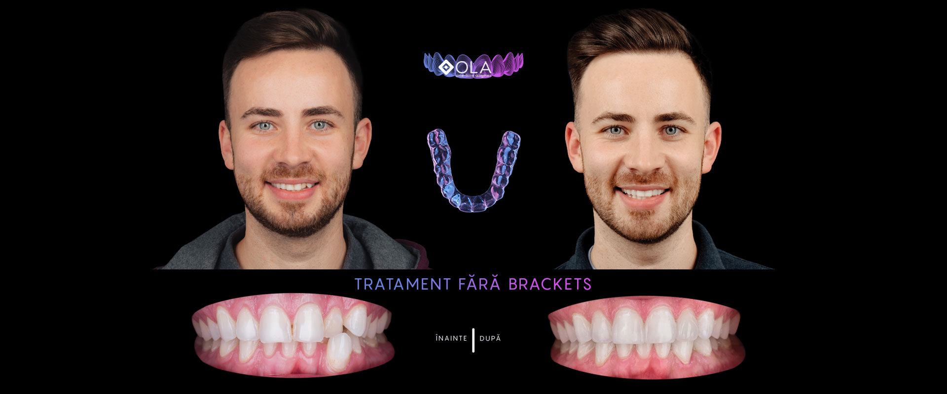 OLA indreptarea dintilor – DentusDentino