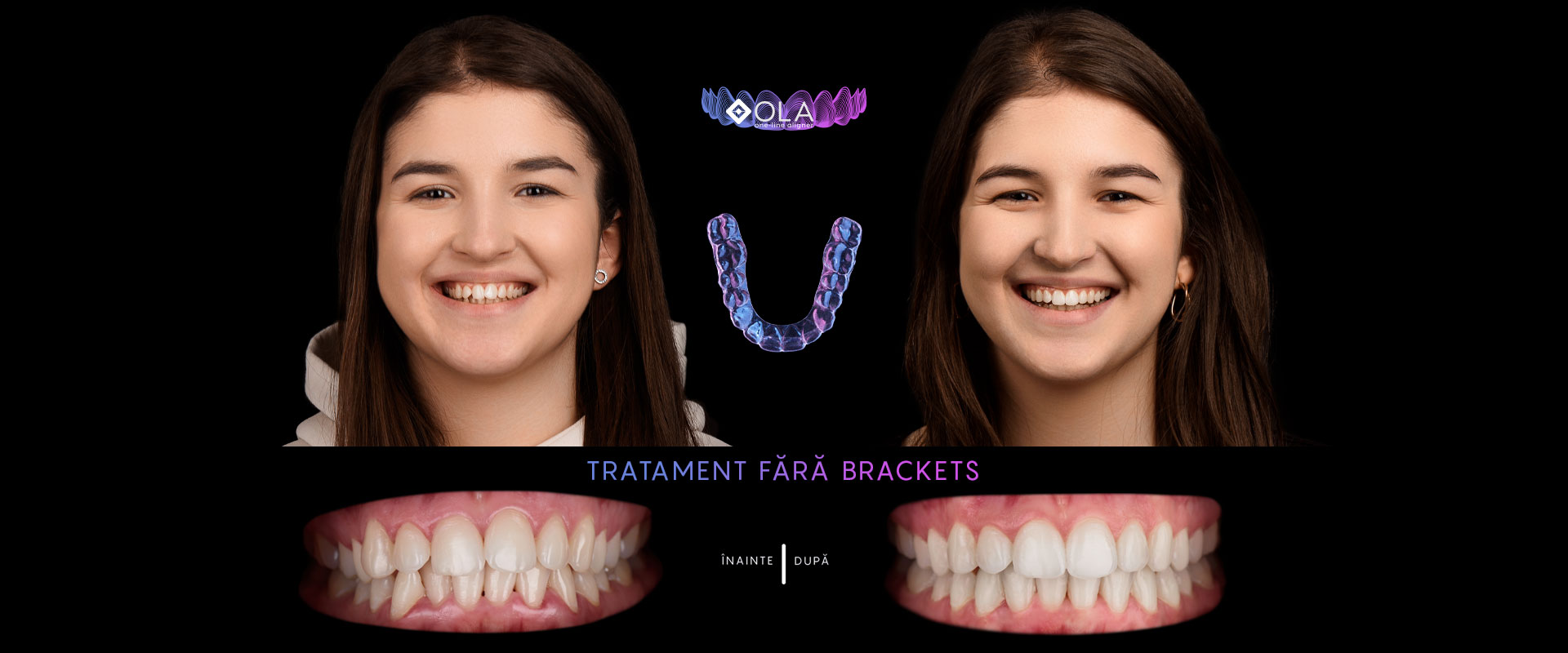OLA indreptarea dintilor – DentusDentino